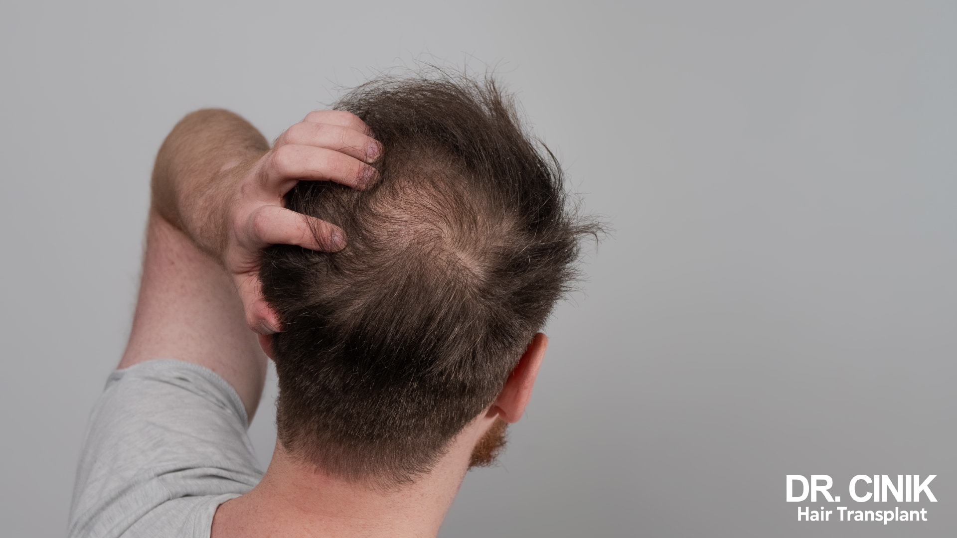 Greffe de cheveux : la solution pour vos cheveux qui s'affinent
