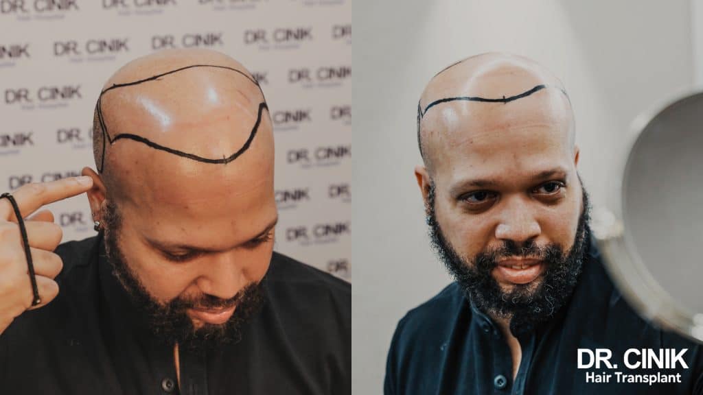 5000-Graft Hair Transplant: Cost and Candidacy Factors