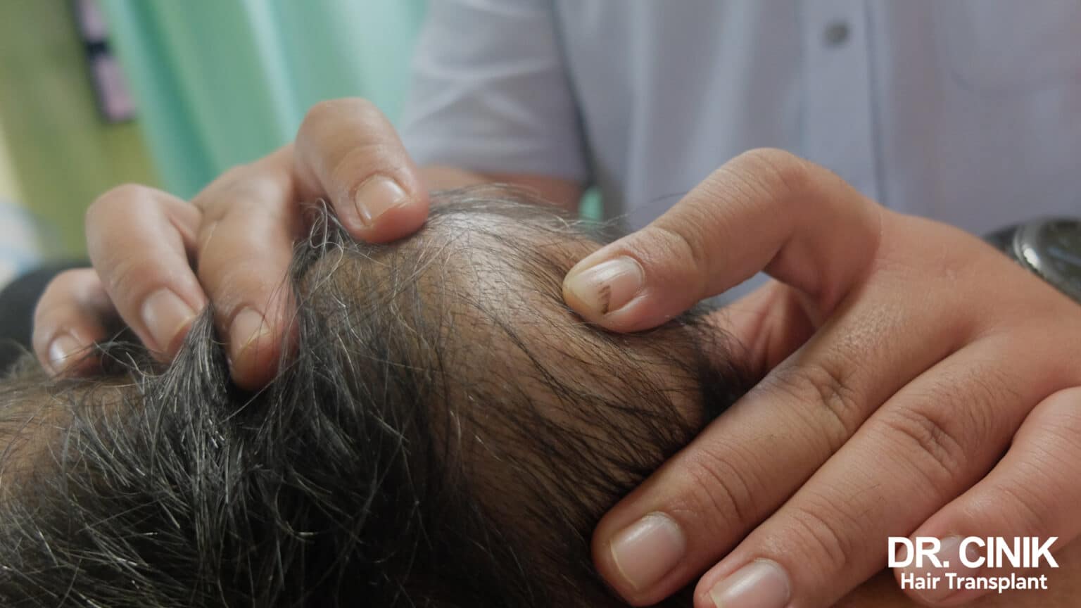 Alopecia Universalis: What is Alopecia Universalis? | Dr Cinik