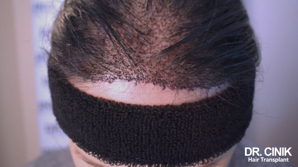 Hair transplant: the solution for thinning hair? | Dr Cinik