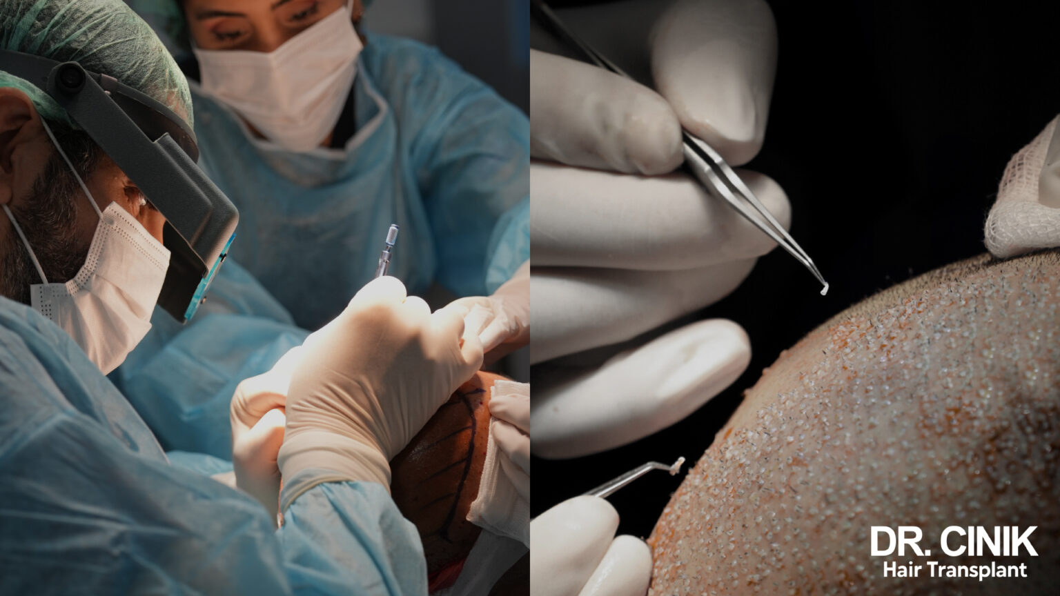 Comparing FUE Variants: Traditional vs. Sapphire vs. DHI vs. Manual vs ...