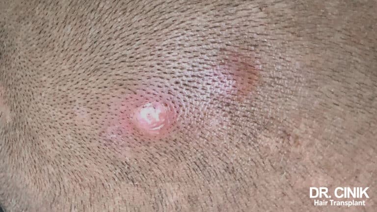 Folliculitis: Causes, Symptoms and Treatments | Dr Cinik