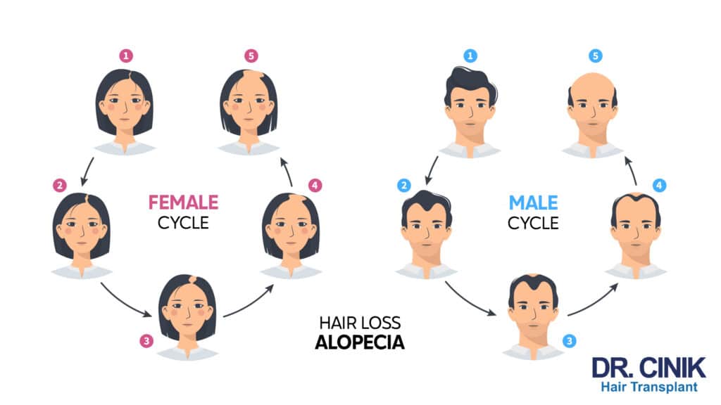 Hereditary Baldness: How to Combat It?