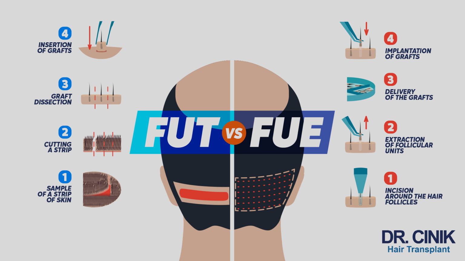 Comparing FUE Variants: Traditional vs. Sapphire vs. DHI vs. Manual vs ...