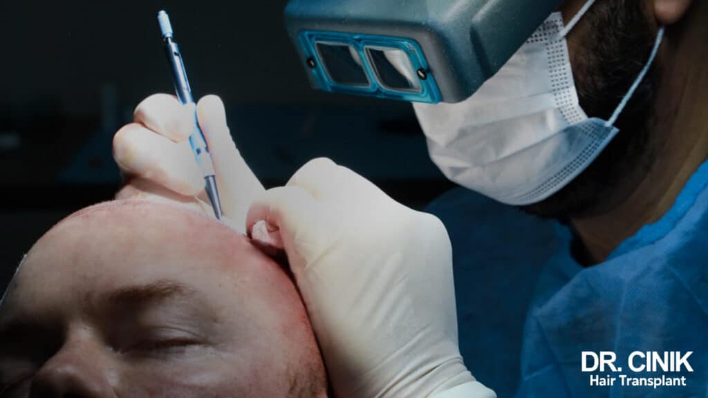 Second Hair Transplant: When and How to Proceed | Dr Cinik