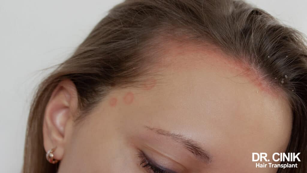 Hair loss and stress: understanding and treating it | Dr Cinik