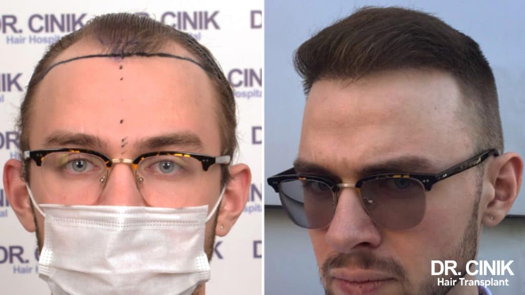 Norwood-Hamilton Scale: What stage of baldness are you in? | Dr. Cinik
