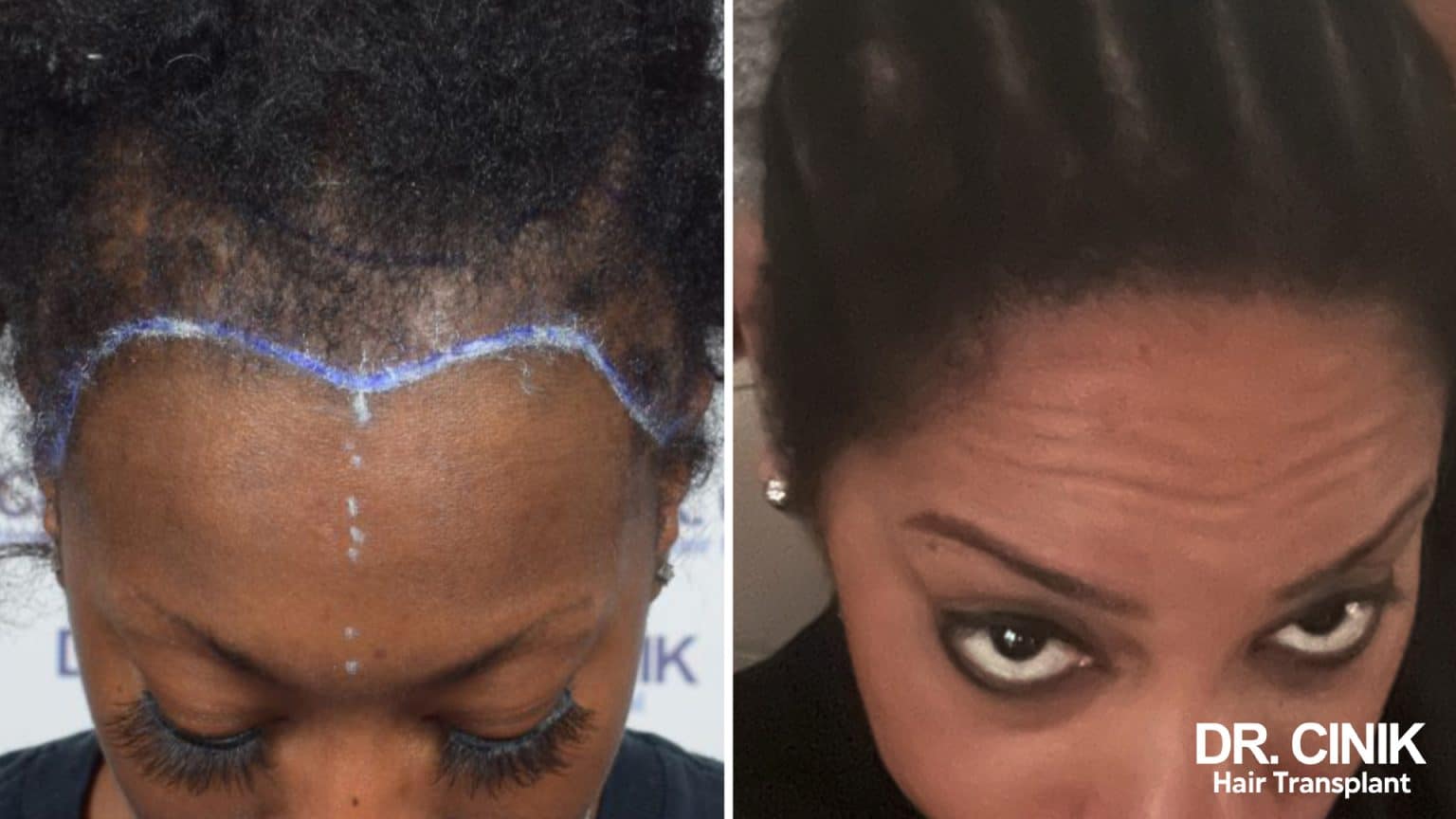 Traction Alopecia: The Consequence of Hair Mistreatment Leading to ...