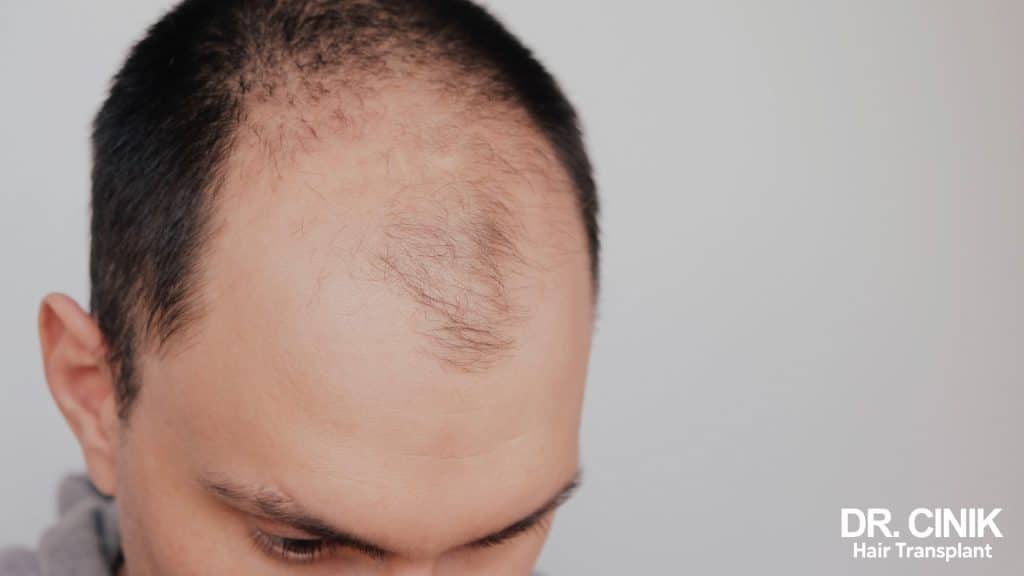 Frontal fibrosing alopecia: understanding and treating this type of ...