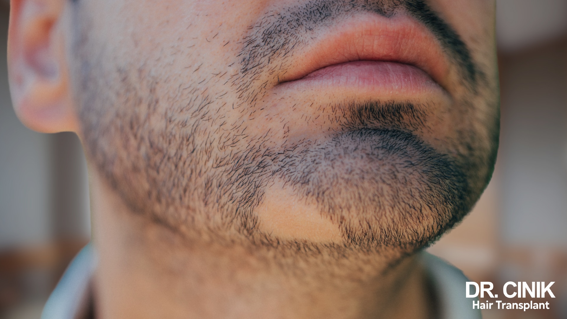 Alopecia barbae : causes, symptômes et traitements