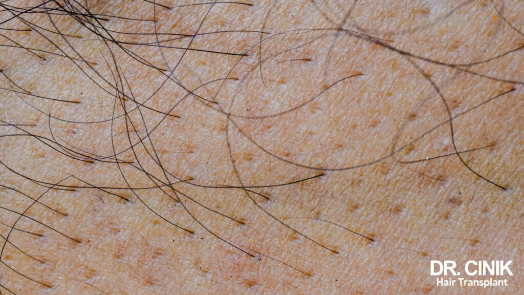 Alopecia Barbae: Causes, Symptoms and Treatments