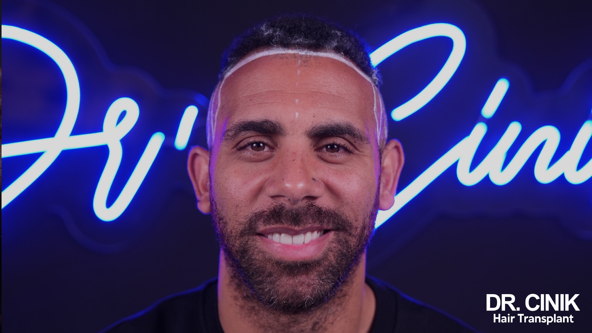 Anton Ferdinand et sa greffe de cheveux : témoignage et photos avant ...