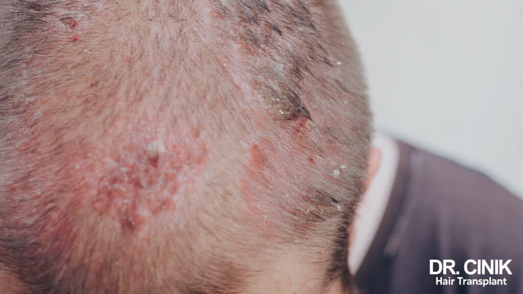Large forehead: causes and solutions | Dr Cinik