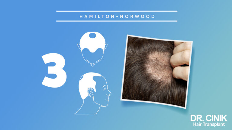 Norwood-Hamilton Scale: What stage of baldness are you in? | Dr. Cinik